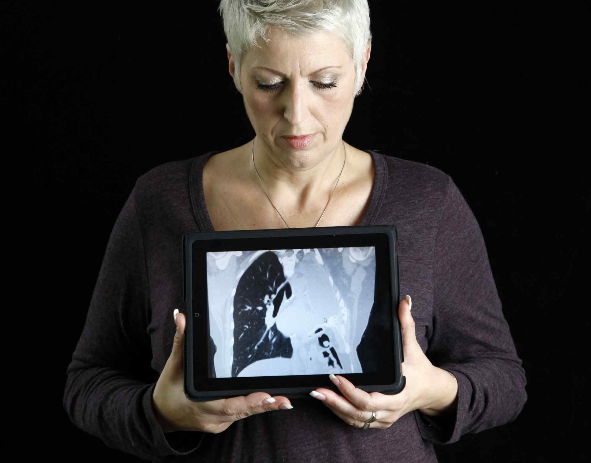 Lung cancer survival rate in England improves - Rumah Sakit UBAYA